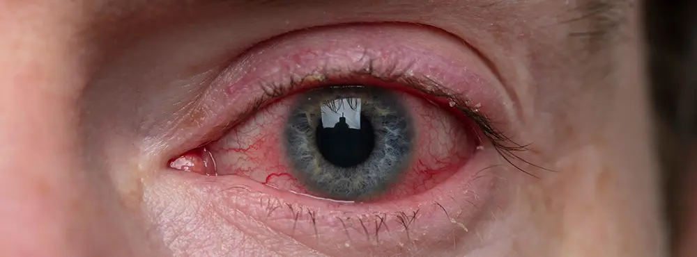 What Are Bloodshot Eyes Causes Treatment More What Are Bloodshot Eyes Causes Treatment More