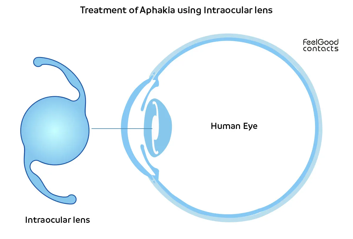 Aphakia – the absence of the crystalline lens of the eye | Feel Good ...